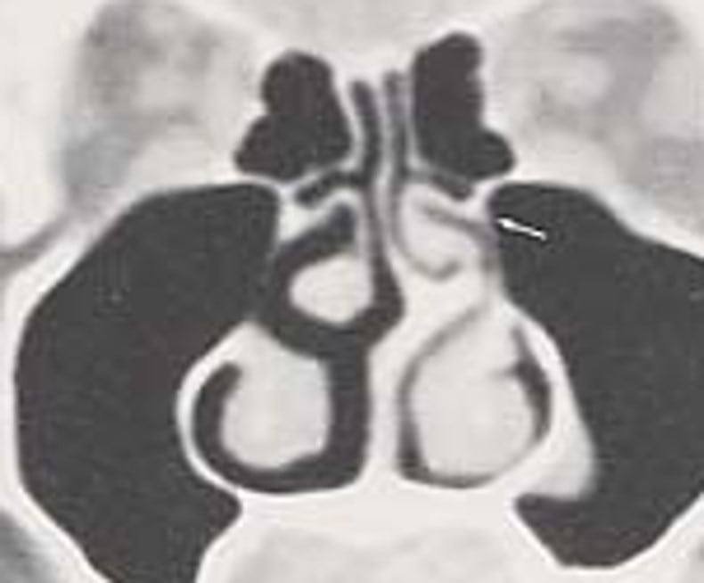 L'apnea notturna in presenza di setto nasale deviato - dr. Luca Guarda ...